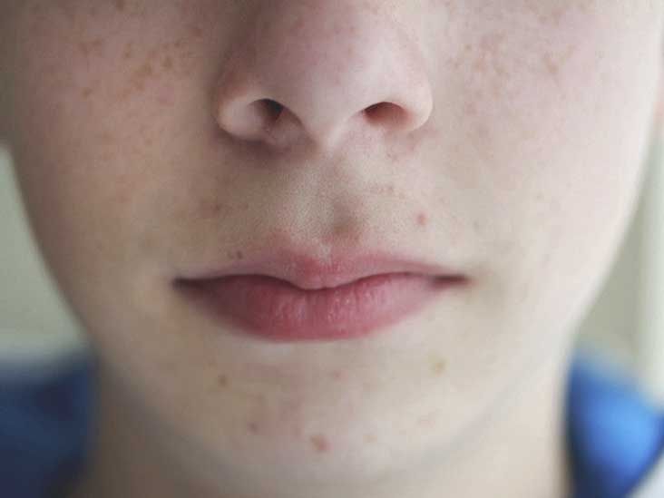 Blue Light Therapy: Uses and Side Effects