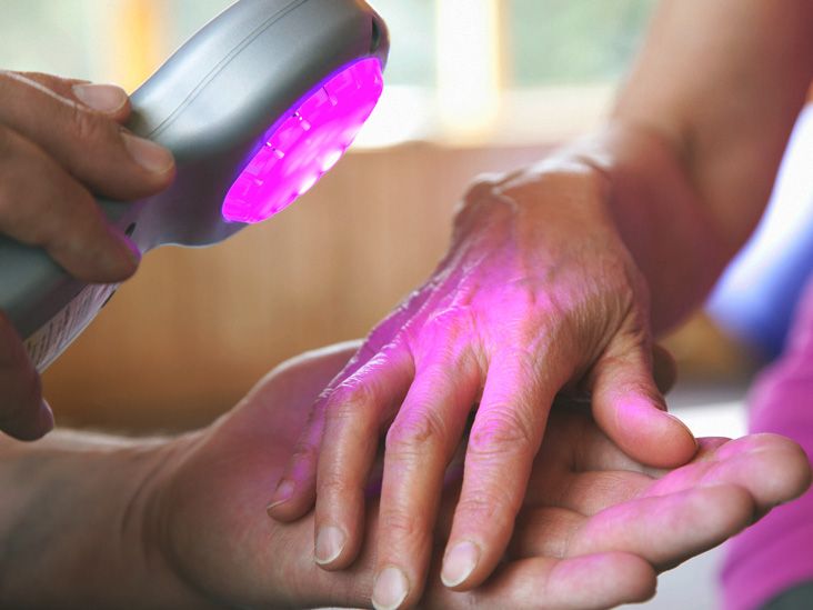 XTRAC Laser Therapy for Psoriasis: Does It Work?