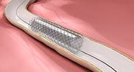 Cardiac Stent: Benefits and How It Works