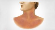Dermatomyositis: Causes, Symptoms, and Treatment
