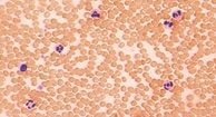 Leukemia: Symptoms, Signs, Causes, Types, and More