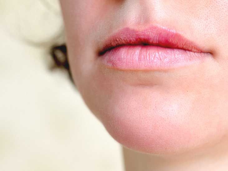 Skin Tags on Lips: Causes and Treatment