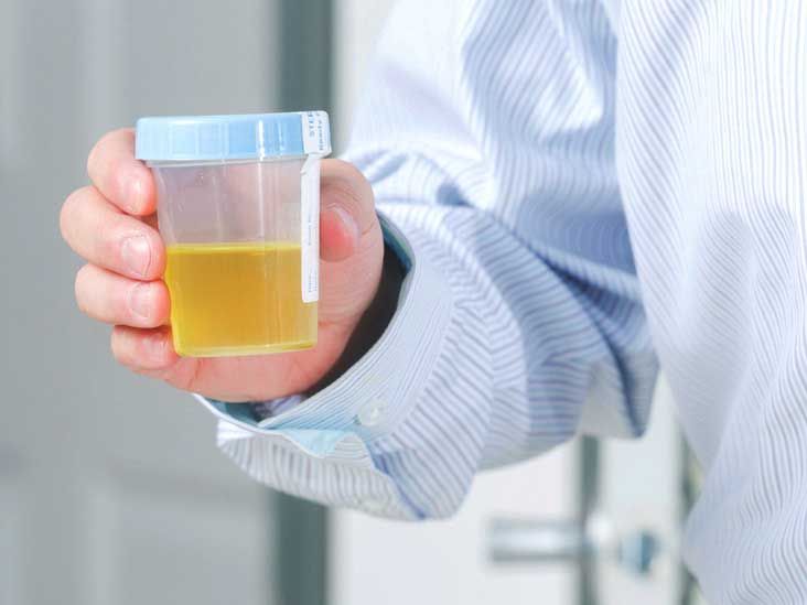 Epithelial Cells in Urine: Types, Test Results, Causes, and More