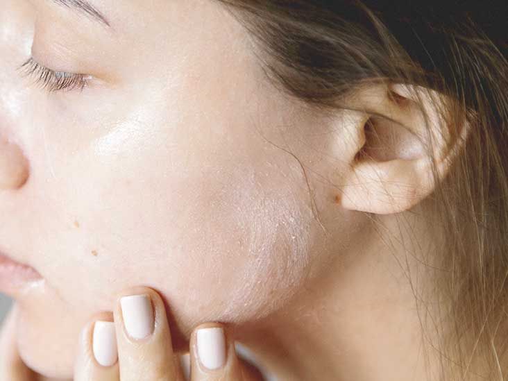 Red Skin Syndrome: Stages, Treatment, Healing, and More