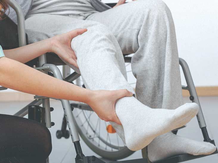 Dependent Edema: Definition, Symptoms, Pitting, and Non-Pitting