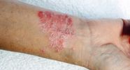 Rashes That Look Like Scabies Causes Symptoms Treatment Rashes That Look Like Scabies Causes Symptoms Treatment