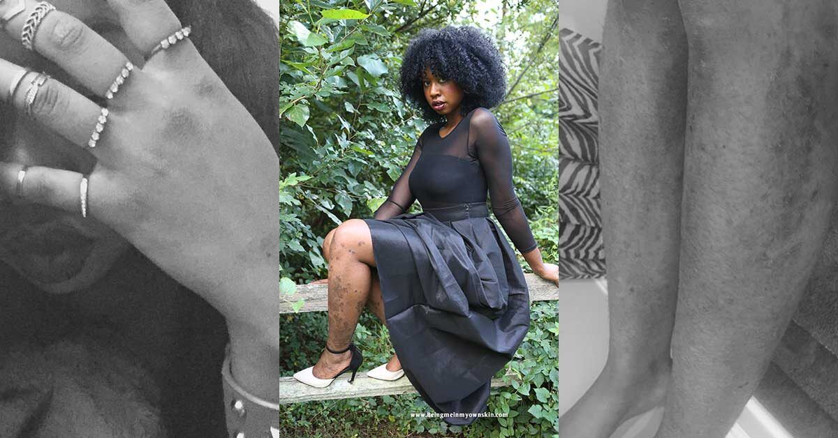 How Psoriasis Impacted My Sex Life — And How A Partner Can Help