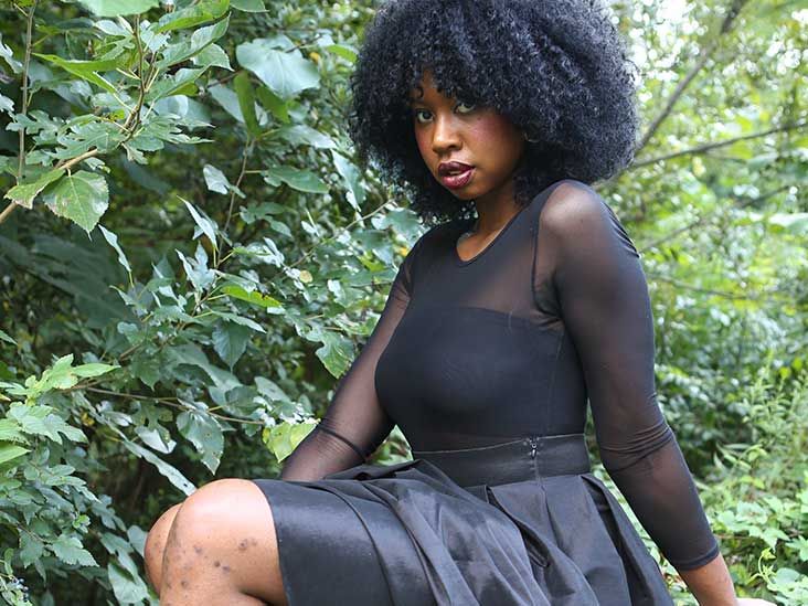 How Psoriasis Impacted My Sex Life — And How A Partner Can Help 4234