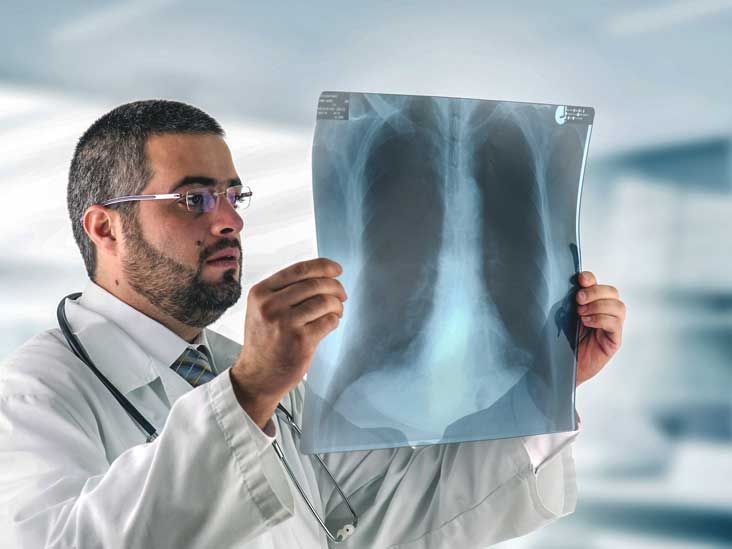 ARDS: Causes, Symptoms, Risks, Diagnosis, and Treatment