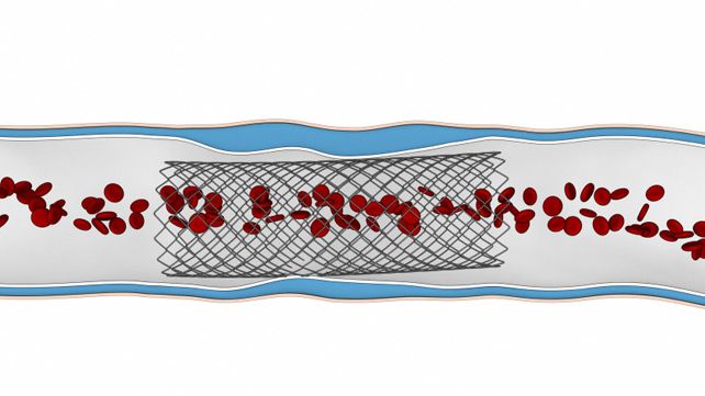 Drug-Eluting Stents: How Do They Work?