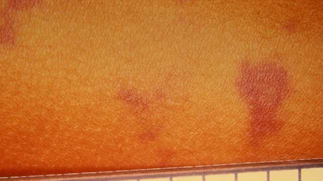 Bacterial Meningitis: Causes and How It’s Spread