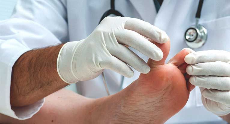 Broken Toe: Symptoms, Recovery, and More