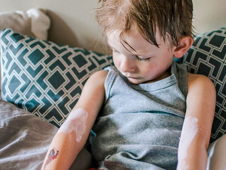 Bedbugs Bites: What They Look Like, Treatment, and More