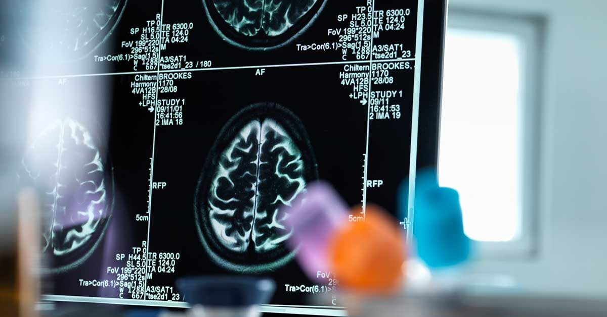 Multiple Sclerosis Treatment: New Test for Brain Iron