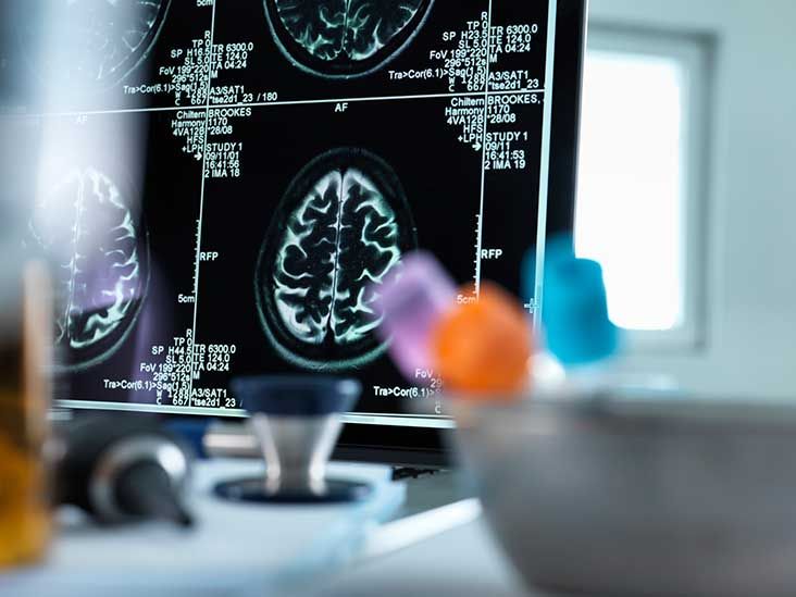 Multiple Sclerosis Treatment: New Test for Brain Iron