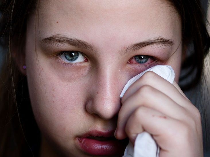 How Long Does Pink Eye Last? Viral vs. Bacterial Pink Eye