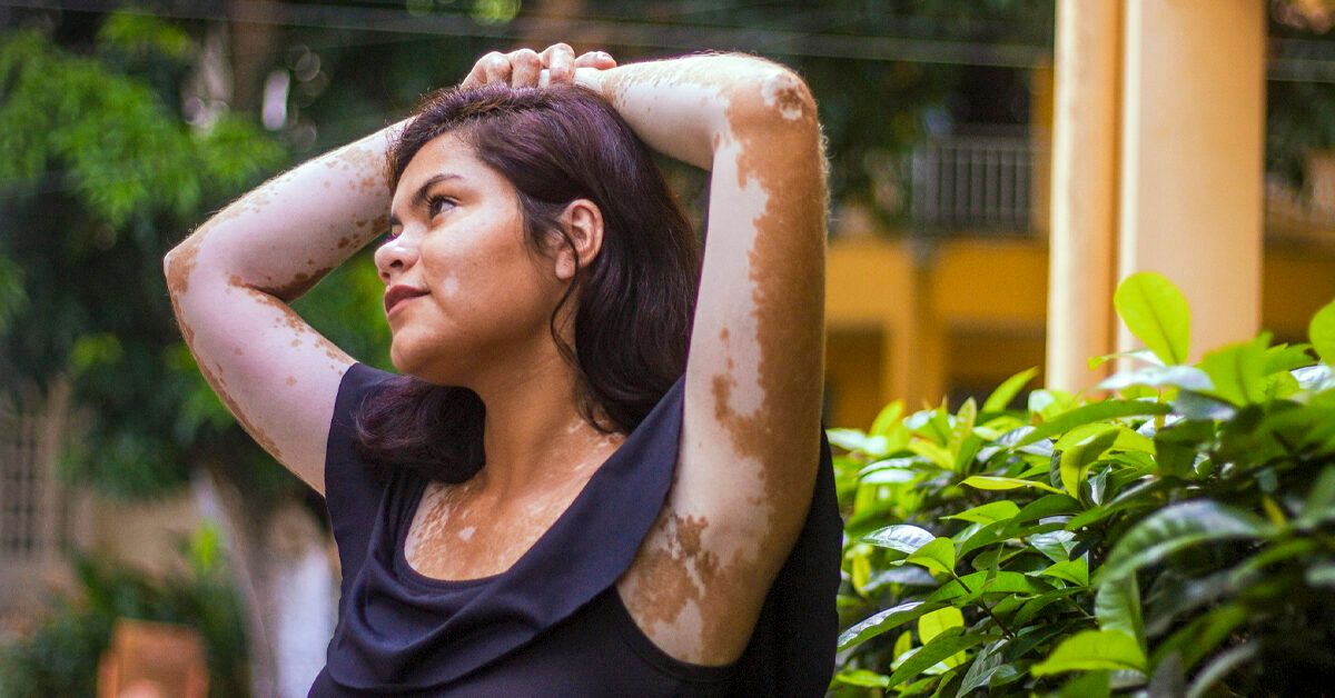 Macule: Identification, Causes, and Treatments