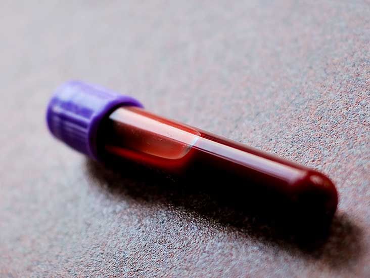 GAD Antibodies and Diabetes: What You Should Know