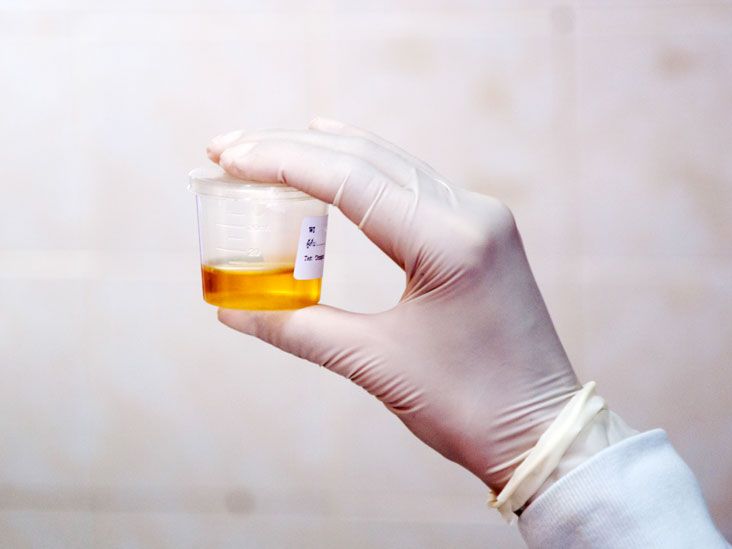 Creatinine Urine Test: Understanding the Test and Results
