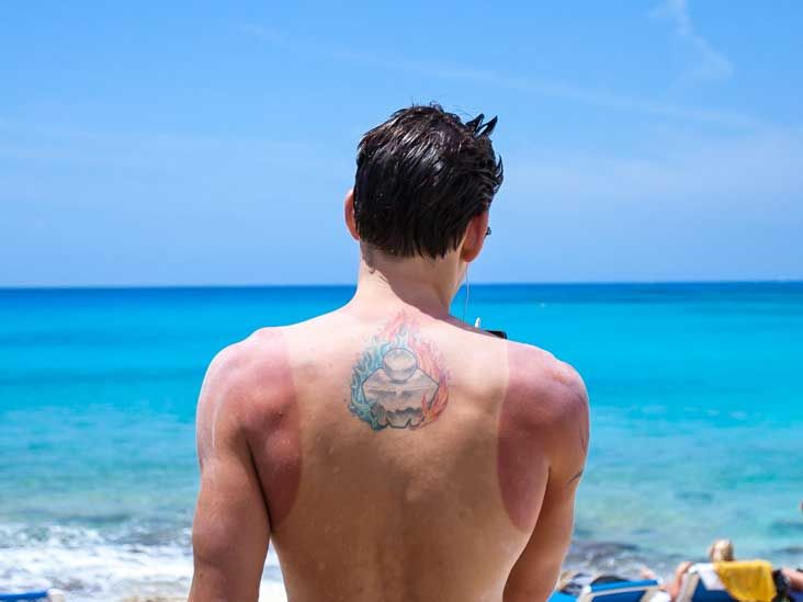 Sunburns and Damage to Your Body