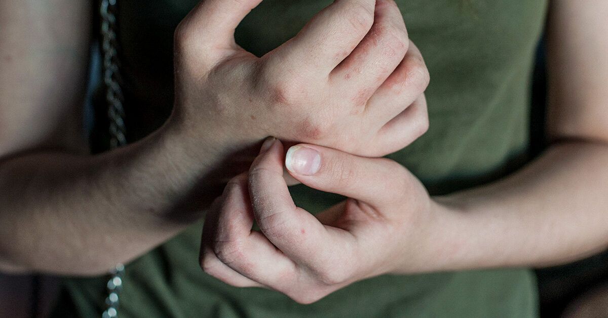 Scabies vs. Eczema: Causes, Symptoms, and Treatment