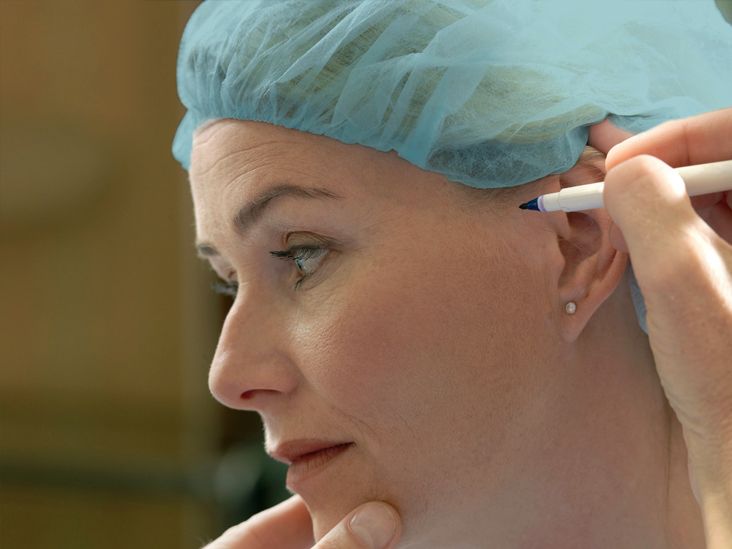 Mid-Facelift: Cost, Procedure, and What to Expect