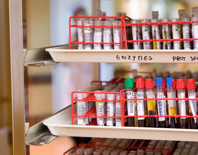 Mononucleosis Spot Test: Overview, Procedure, and Complications