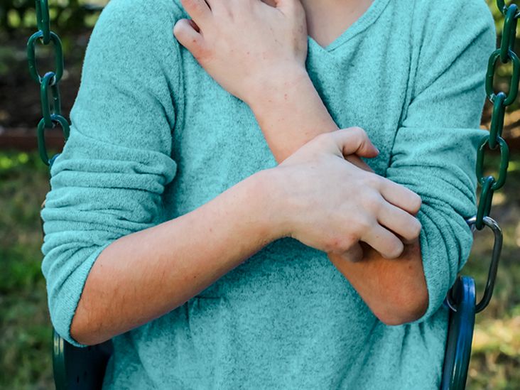 Bugs that Burrow Under Skin, and What to Do About Them