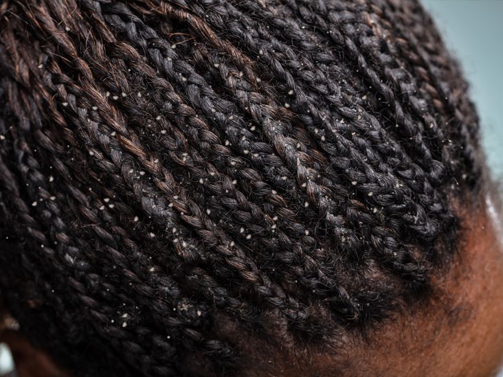 Types of Dandruff: Causes, Treatment, Prevention