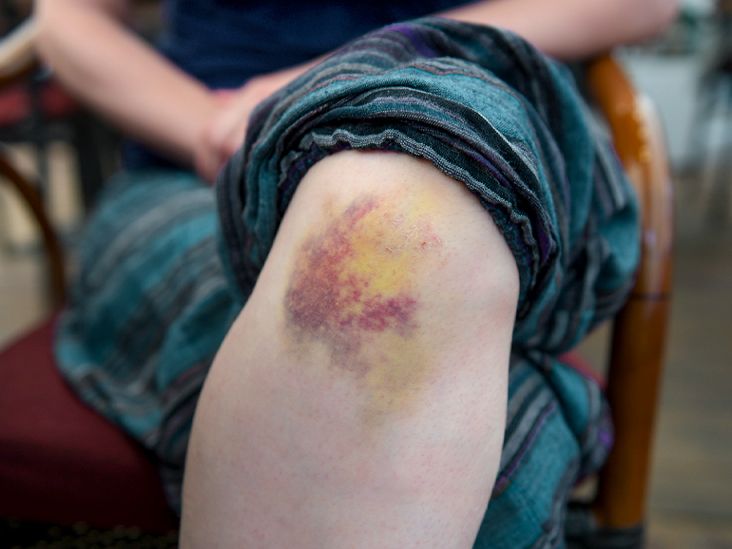 Bruised Sternum Sternum Fracture Symptoms Causes