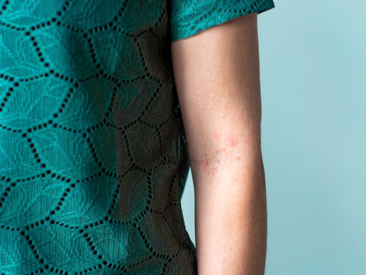 Autoimmune Hives: Causes, Symptoms, Treatments, and More