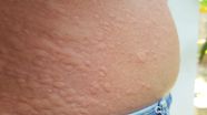 Liver Rashes