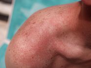 Miliaria Forehead