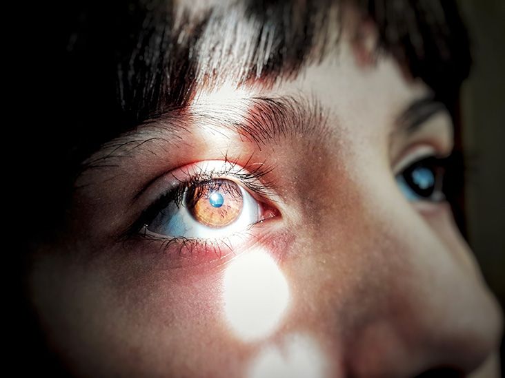 Myopic Macular Degeneration: Causes, Risk Factors, Treatment