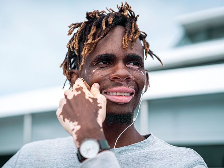 What Does Vitiligo Look Like? Pictures, Treatment, and More