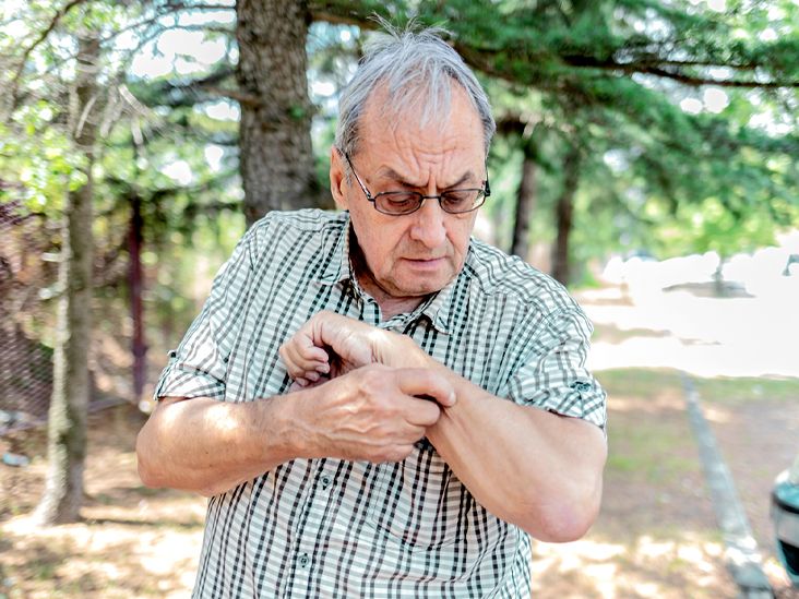 Mange in Humans: Symptoms, Treatment, and More