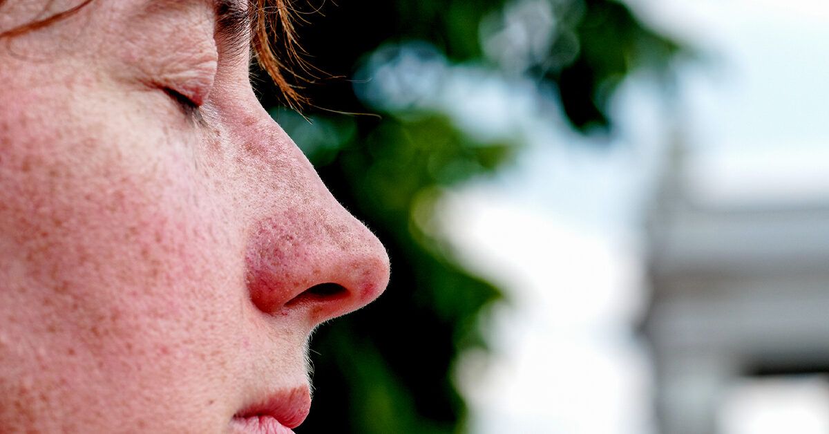 Stevens-Johnson Syndrome: Causes, Diagnosis, and Treatment