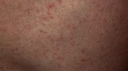 Strep Rash