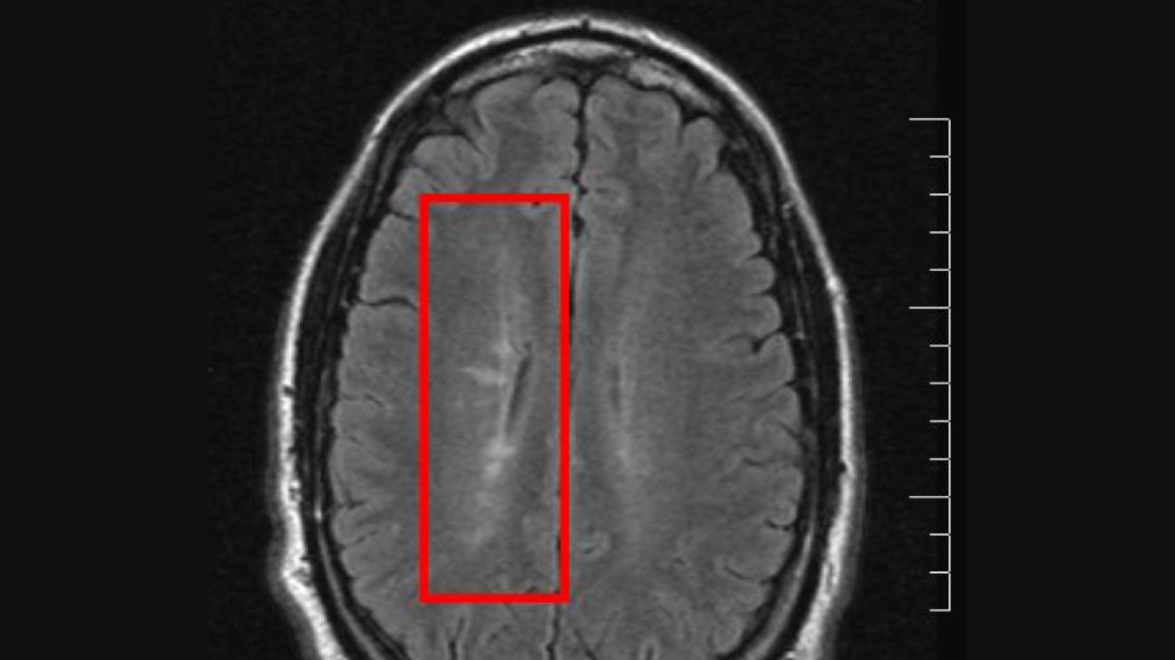 Multiple Sclerosis Mri Dawsons Fingers Multiple Sclerosis (Chapter 22)
