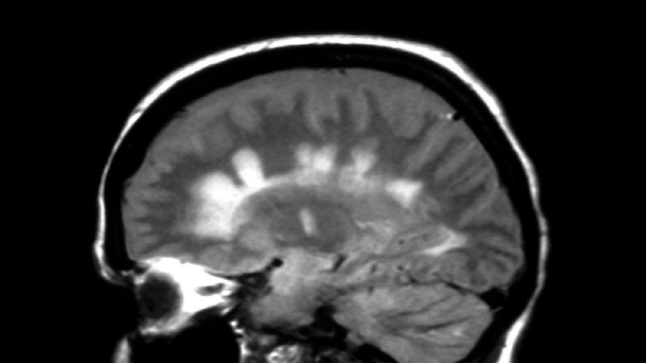 Multiple Sclerosis Mri Dawsons Fingers Multiple Sclerosis (Chapter 22)