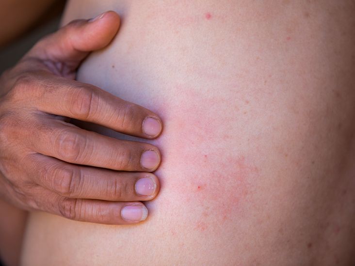 Celiac Disease and Shingles: Are They Connected?