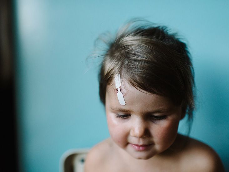 Epilepsy After Concussion: Risks and Treatment