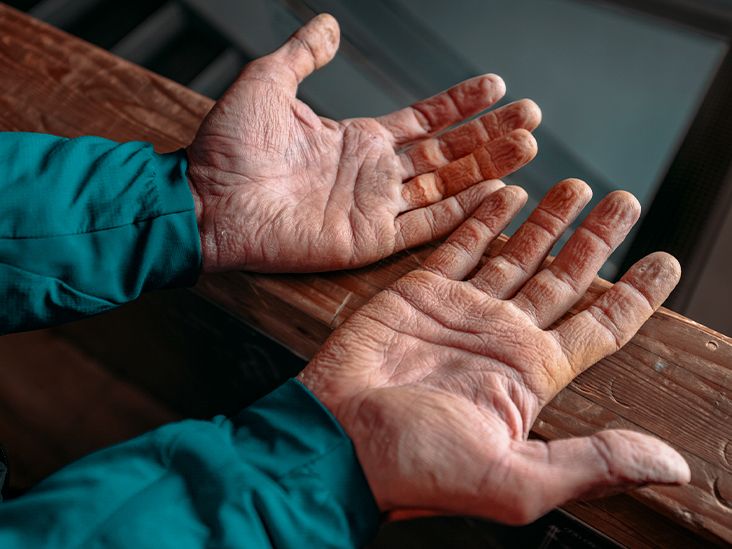 Acute Palmoplantar Eczema: Causes, Diagnosis, and Treatment