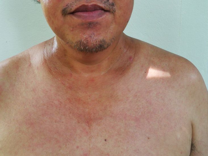 Small Cell Lung Cancer with Hyperpigmentation