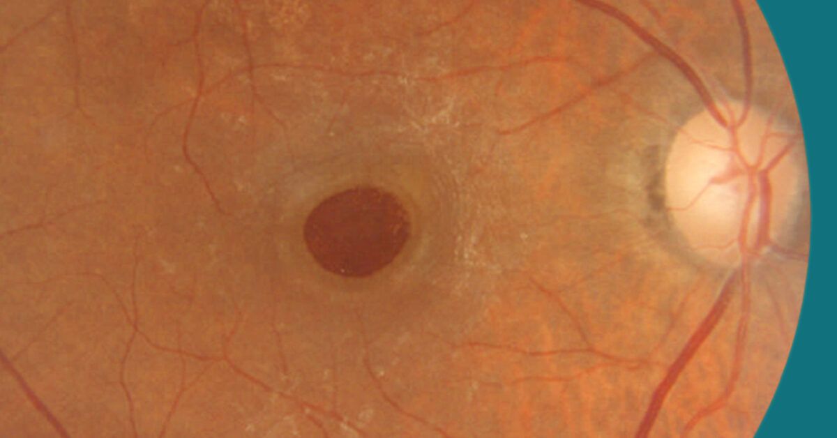 Macular Hole: Diagnosing and Treating This Tricky Eye Problem