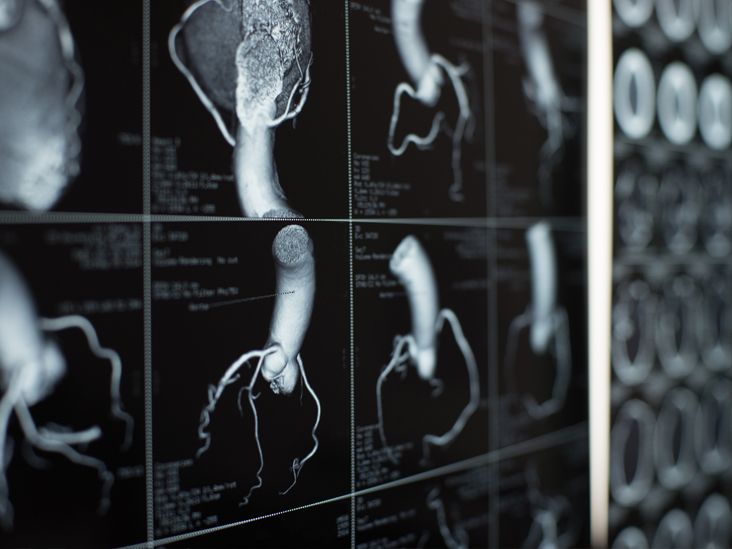 Cholesterol Artery Test: Coronary Artery Calcium Test and Score