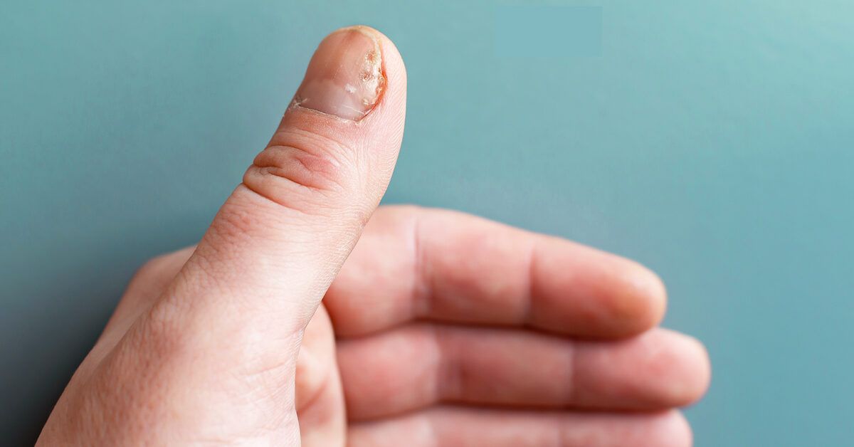 Nail Psoriasis Severity Index: What It Is and How Doctors Use It