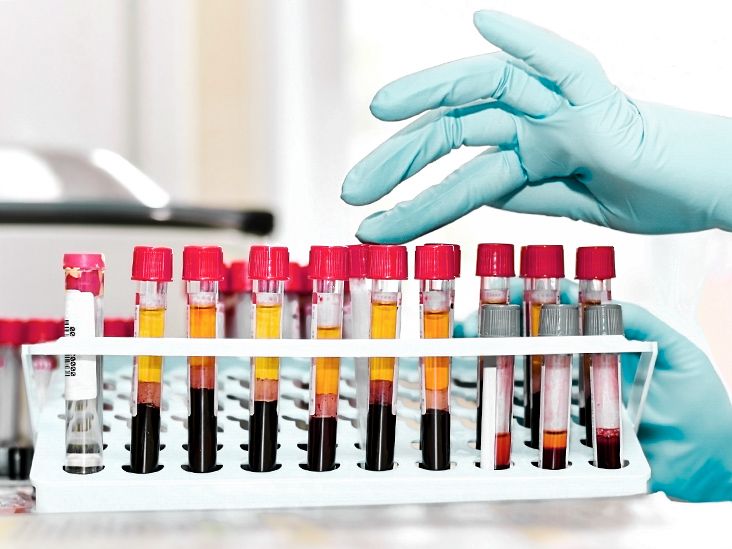 Leukemoid Reaction: Types, Symptoms, Treatment, Outlook, and More