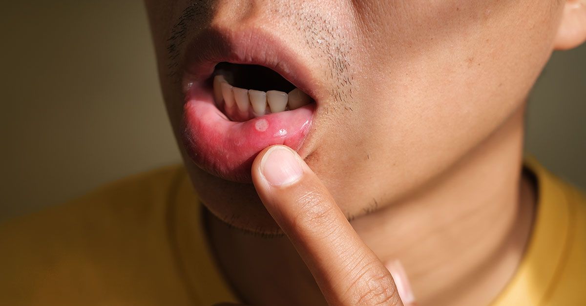 Mouth Ulcer Causes and When to Get Help