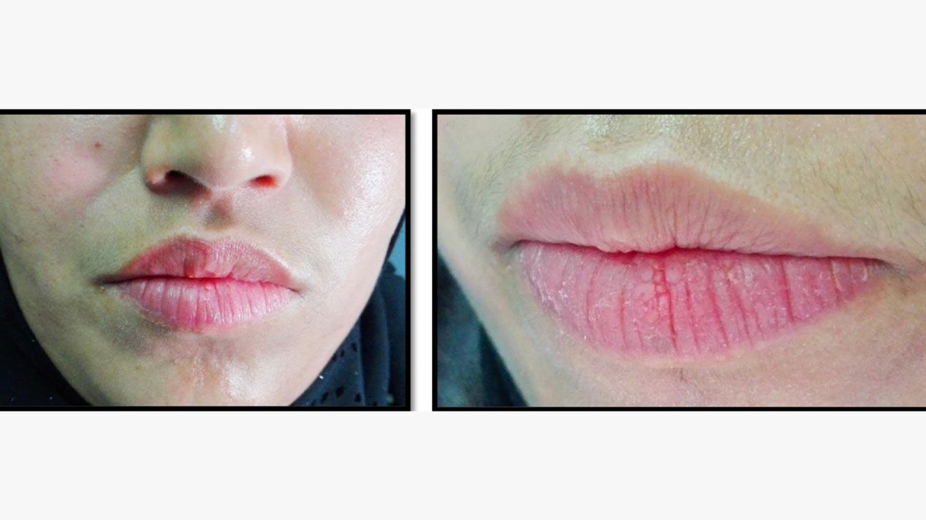 Psoriasis On The Tongue Symptoms Treatment And Prevention Candida Die